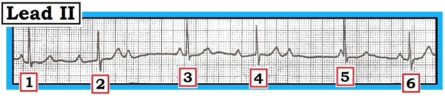 ECG Interpretation: ECG Blog #63 — Escape from Mobitz I