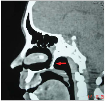 ENT for medical students: NOSE - Congenital