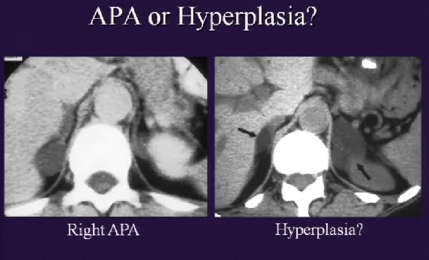 rsna: adrenal adenoma