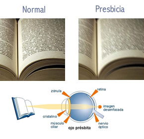 PREVENIR LA CEGUERA: ¿TIENES PRESBICIA?
