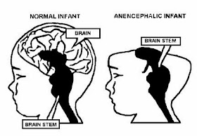 Kassidy Johnston's Story of Anencephaly: What is anencephaly?