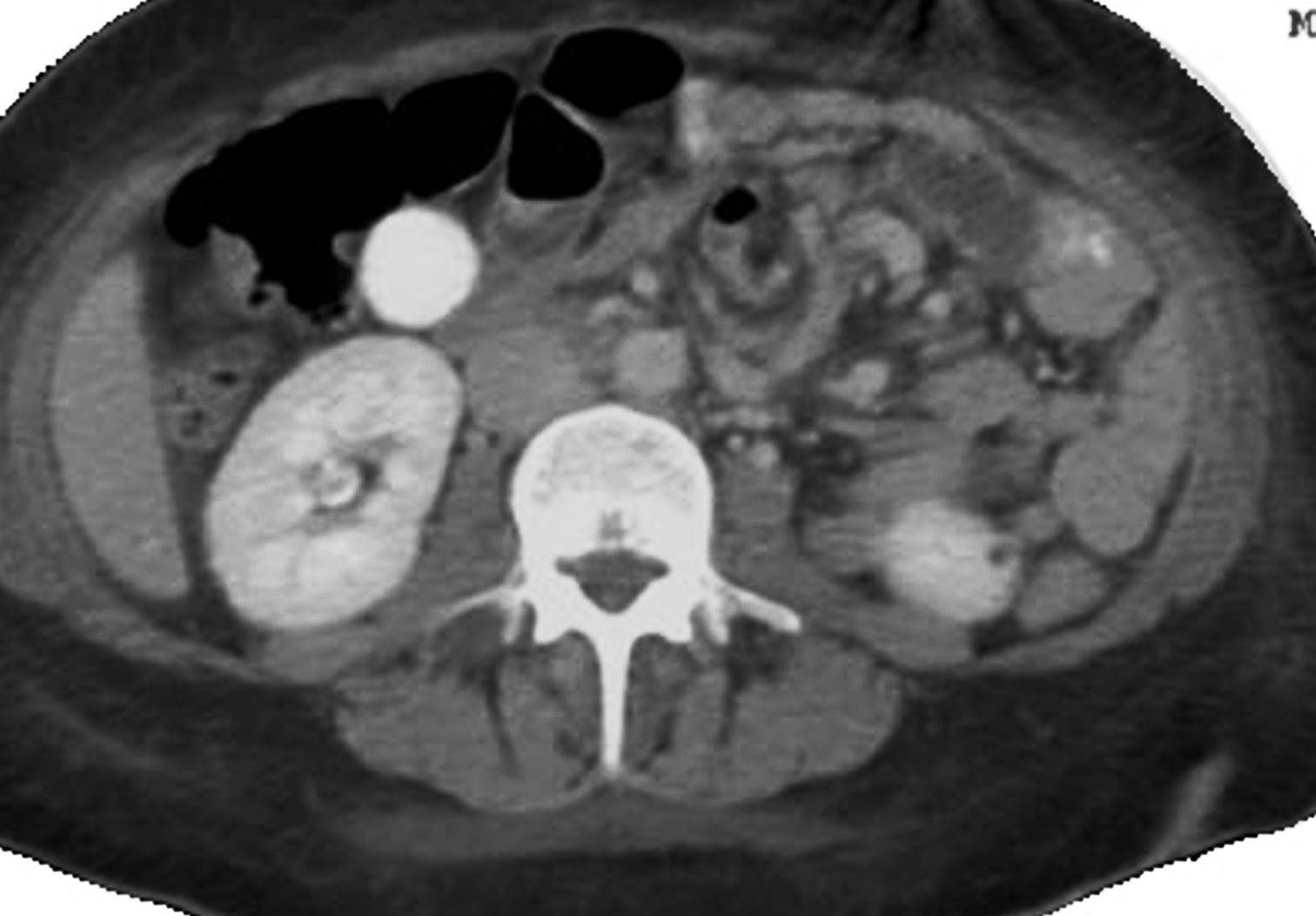 medical mistakes: More on the CT whirl sign of volvulus