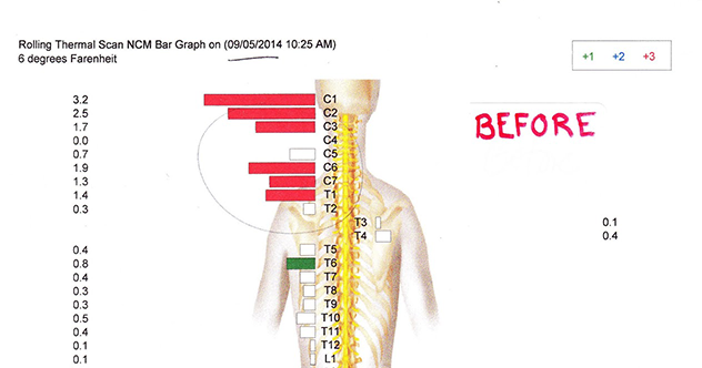 My Torticollis Baby: Re-Scan After 6 Chiropractic Adjustments