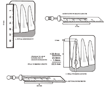 Radiographic Apex Location - Endodontics and Oral Implantology