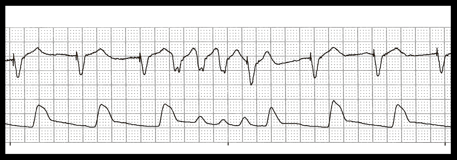 Practice Rhythm Strips 276