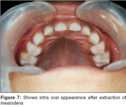 SUHASIS ONLINE: Erupted maxillary conical mesiodens in deciduous ...