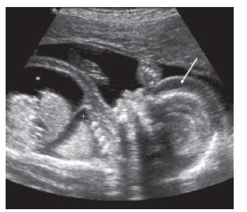 hEiDiMatEs - MeDICinE: Quintero staging system - twin to twin ...