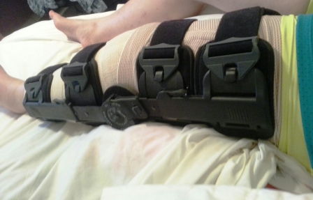 2013: Knee Surgery at 23: Photos Following the Fulkerson Osteotomy