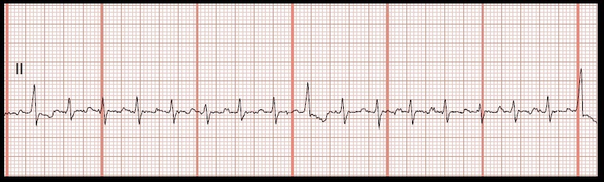 EKG Rhythm Strip Quiz 173