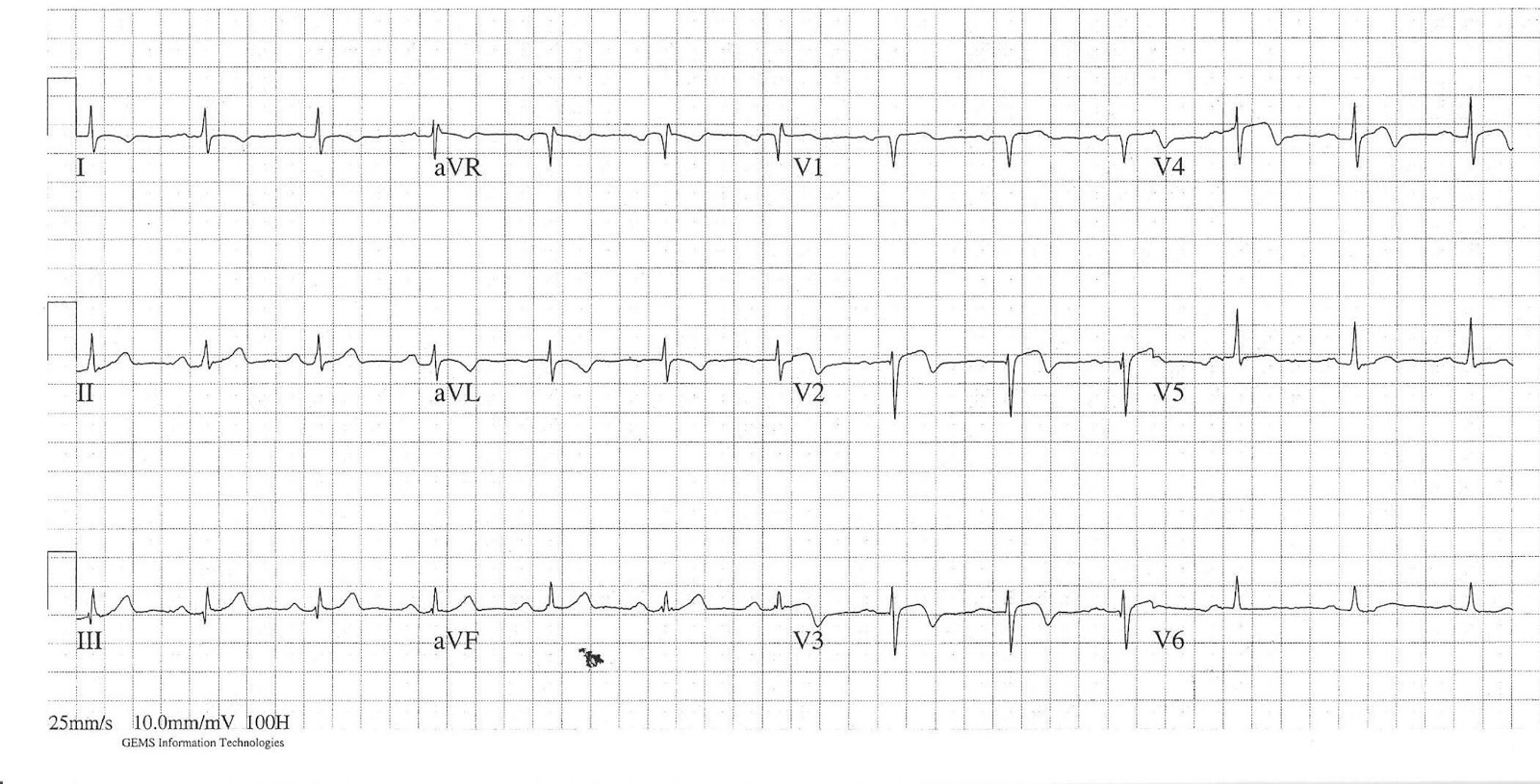 ECG of the Week: ECG of the Week - 7th January 2013