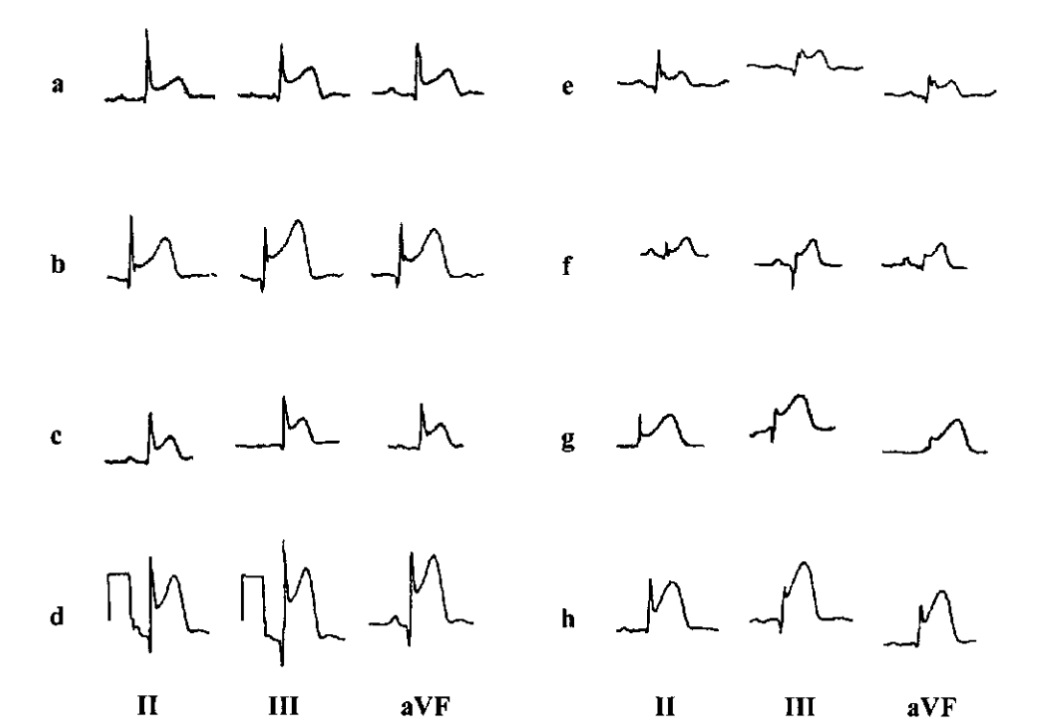 Emergency Medicine Curiosa: Tombstone STEMI (but echo llooks great!)