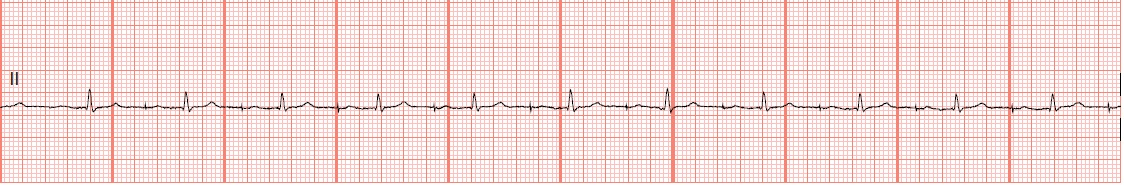 EKG Rhythm Strip Quiz 56: Paced Rhythms
