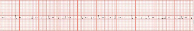 EKG Rhythm Strip Quiz 56: Paced Rhythms