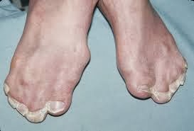 Medical Treatment Pictures-for Better Understanding: Jackson-Weiss Syndrome