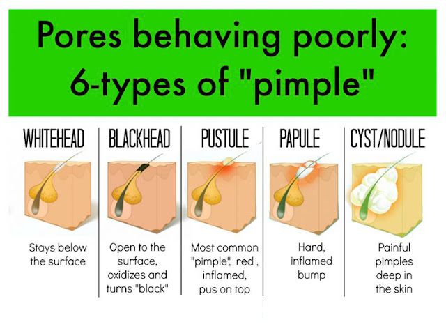 types of pimples different types of acne