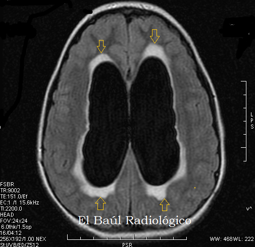 El Baúl Radiológico: 3) EDEMA TRANSEPENDIMARIO EN EL SISTEMA NERVIOSO ...