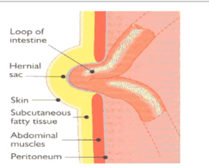 Study Medical Photos: Brief Description Of Abdominal Wall Hernias