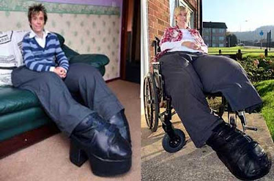 Nothing To Do With Arbroath: Woman's giant leg starts growing back ...