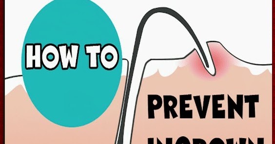How to Properly Remove Ingrown Hair