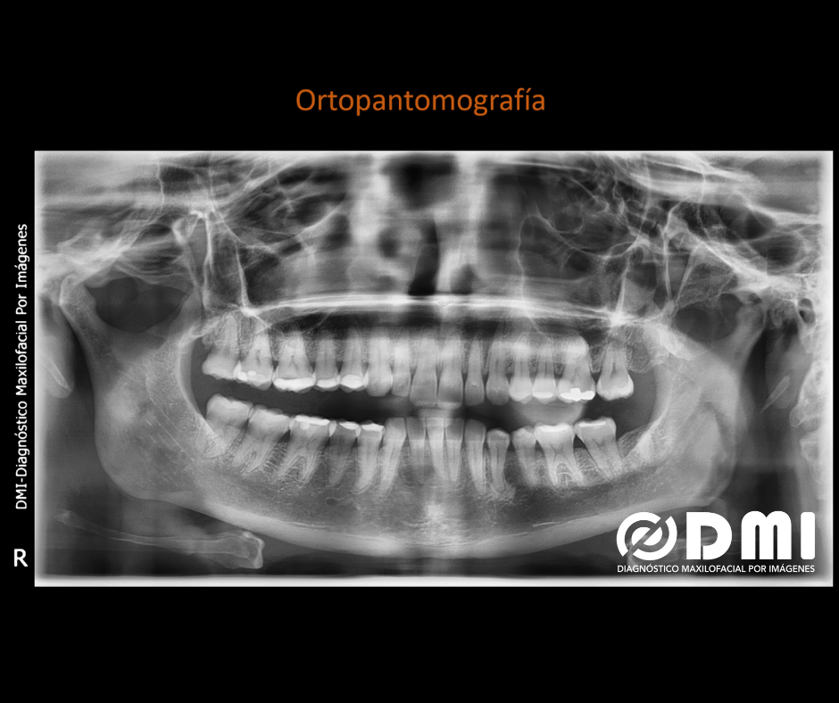 Diagnóstico Maxilofacial por Imágenes: Caso 05_ Artropatía de ATM