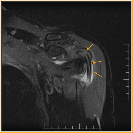 Long Head Biceps Tear-MRI - Sumer's Radiology Blog