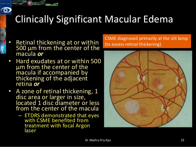 BOKISSONTHRONE: How is Macular Oedema and Diabetic Retinopathy Treated