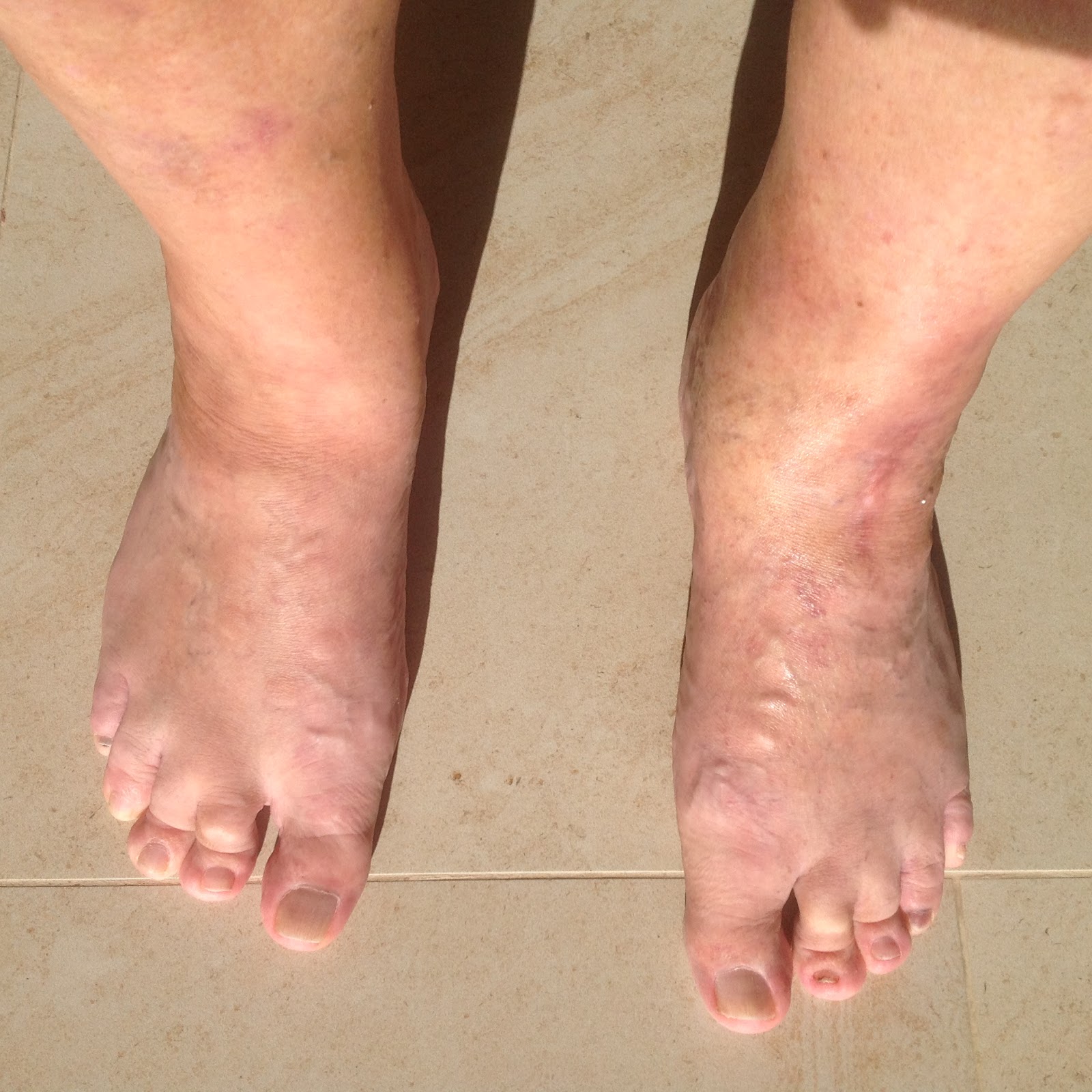 ANKLE SURGERY - PREPARATION AND RECOVERY: 2016