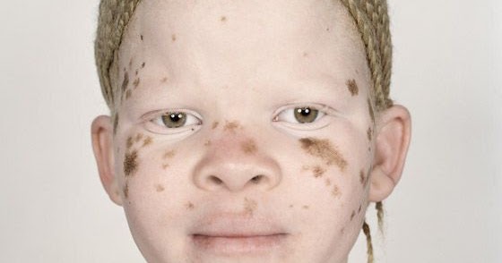 Why do Albinos develop dark mole on their skin? - Greatness In Albinism