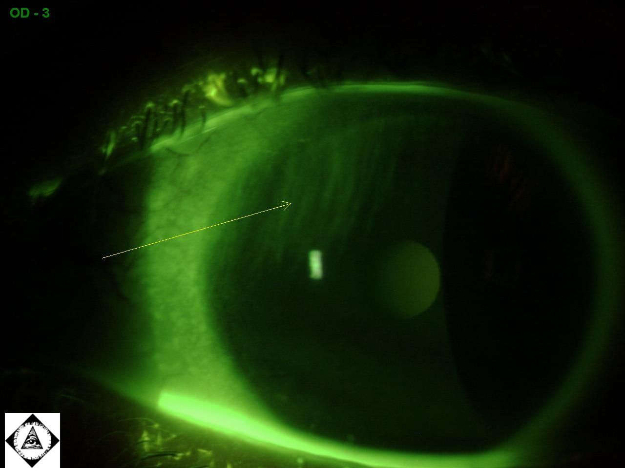 Sonoran Desert Eye Center: FOREIGN BODY UNDER UPPER LID