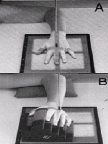 Teknik pemeriksaan X Ray Manus - Seputar Kesehatan