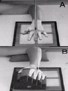 Teknik pemeriksaan X Ray Manus - Seputar Kesehatan