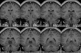 Dr Balaji Anvekar FRCR: Venous Angioma