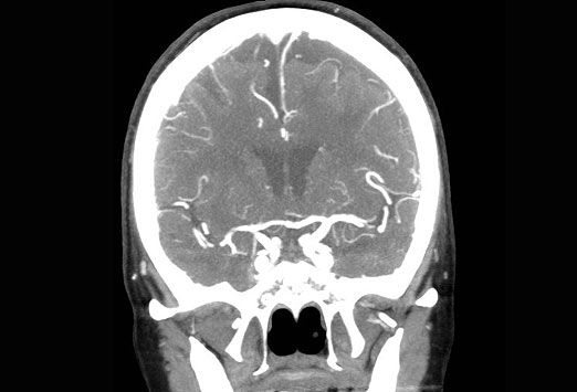 World's Tragic In Medlife,.....You May Know Or Not: 5 Stroke Cases Not ...