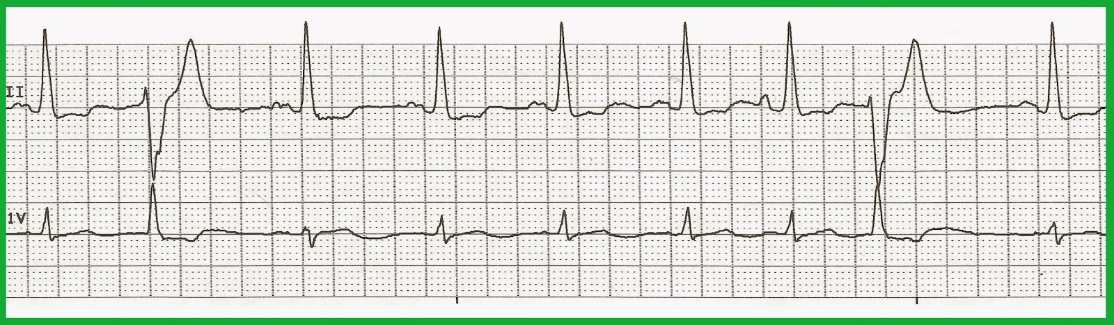 EKG Rhythm Strip Quiz 198