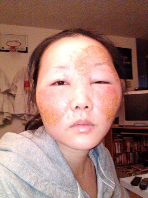 My Staph Story: My Staph Story