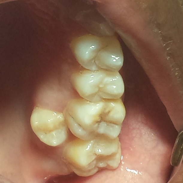 Deformutilation: Hyperdontia