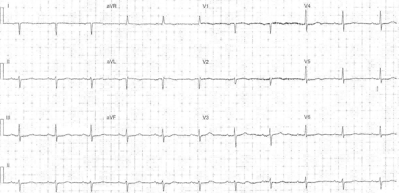 ECG of the Week: ECG of the Week - 9th July 2018 - Interpretation
