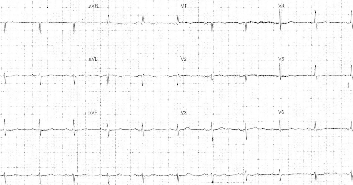 ECG of the Week: ECG of the Week - 9th July 2018 - Interpretation