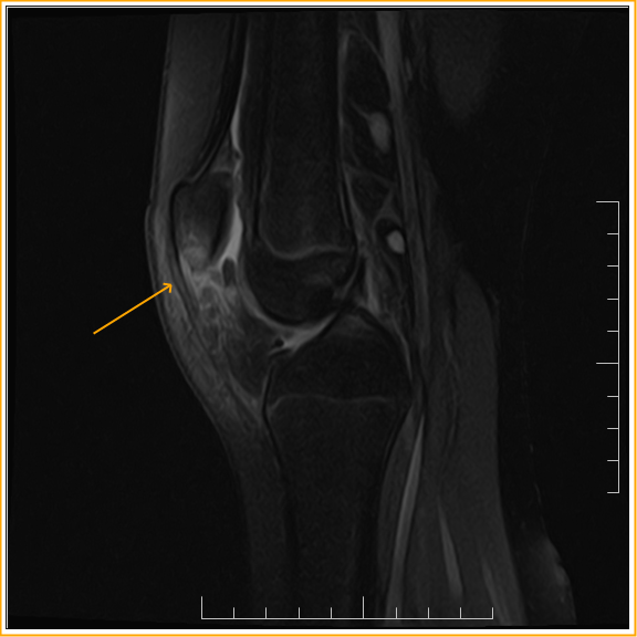 Lateral patellar dislocation - Sumer's Radiology Blog