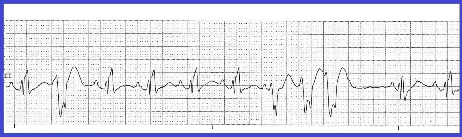 EKG Rhythm Strip Quiz 180