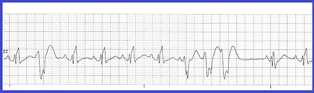 EKG Rhythm Strip Quiz 180