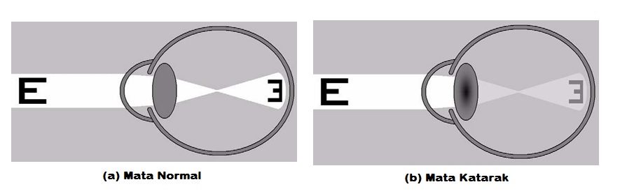 Phacoemulsification untuk operasi katarak | Biomedical Engineering ...