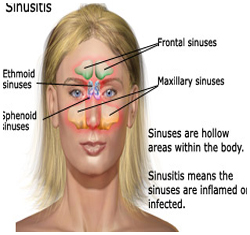 Ciri-ciri Sinusitis: Ciri Ciri Sinusitis dan Pengobatannya