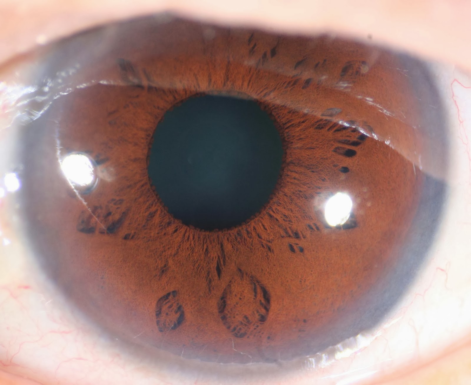 Modern & Multidimensional Iridology: Inner Pupillary Border - Standard ...