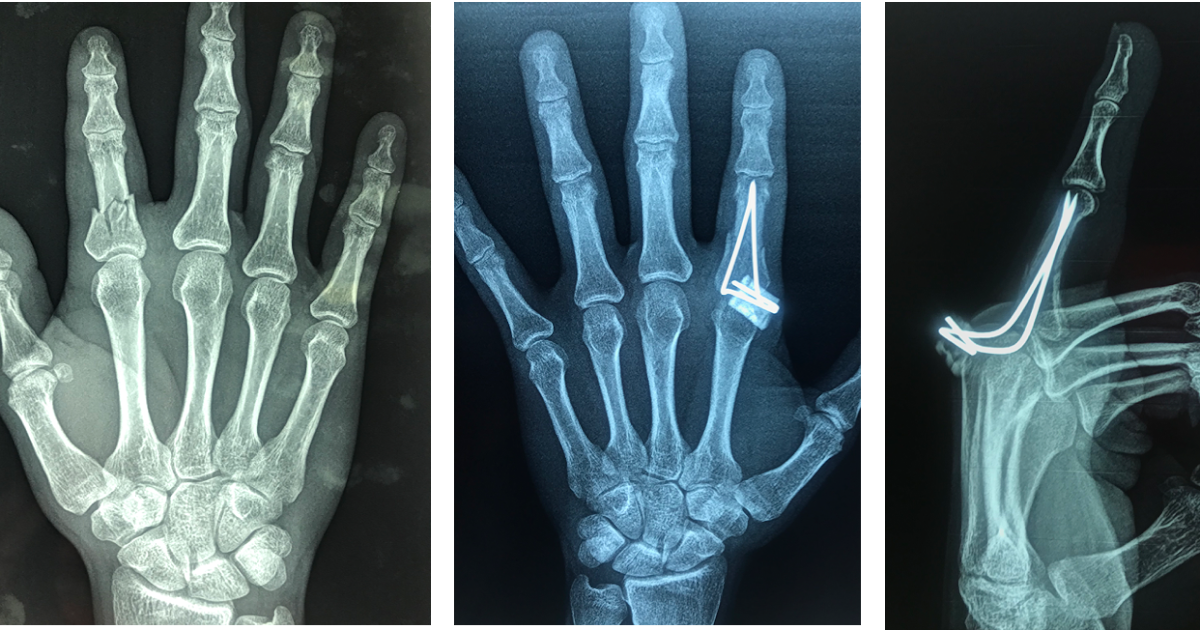 CASOS CLÍNICOS: MINIFIX HÍBRIDO DINÁMICO EN LA FRACTURA DE LA FALANGE ...