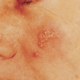 Face Herpes Symptoms And Treatments: Face Herpes Pictures