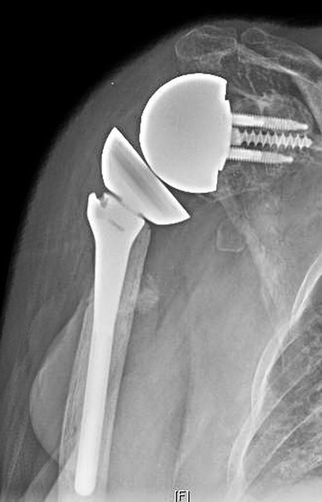 UW Shoulder and Elbow Academy: The failed reverse total shoulder - what ...