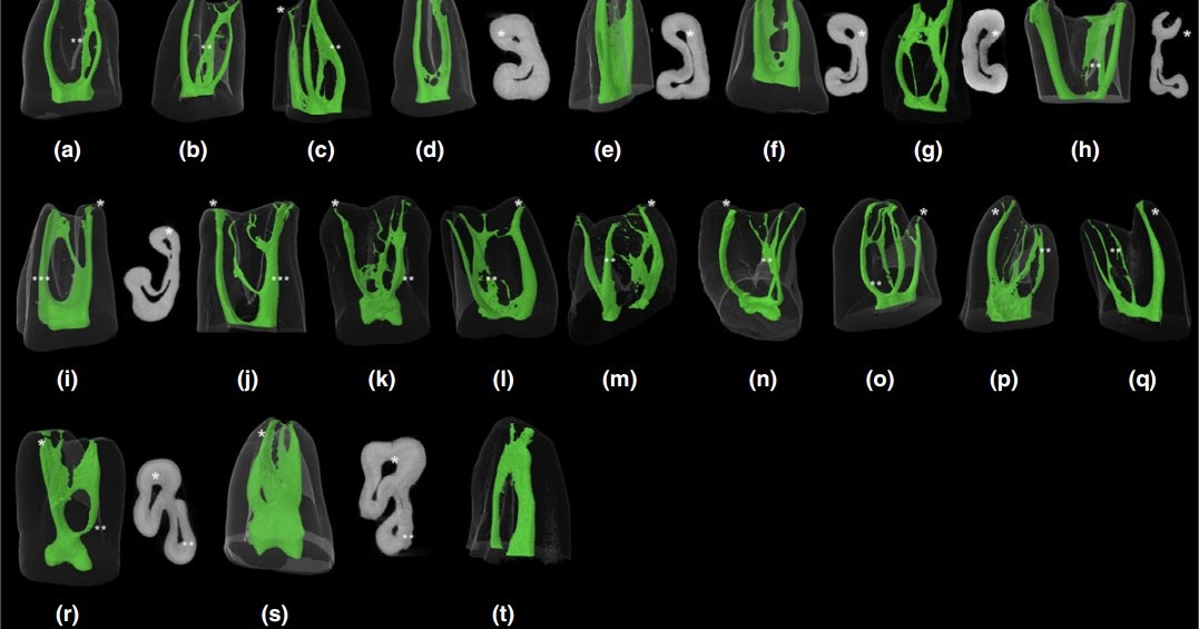 The Root Canal Anatomy Project: Fused Maxillary 2nd Molars ...