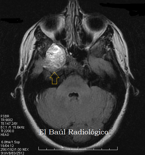 El Baúl Radiológico: 2) QUISTE DERMOIDE INTRACRANEAL (Intracranial ...
