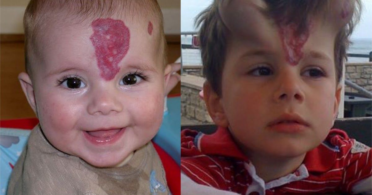 5yr old boy endures horn implants so surgeons can remove birthmark